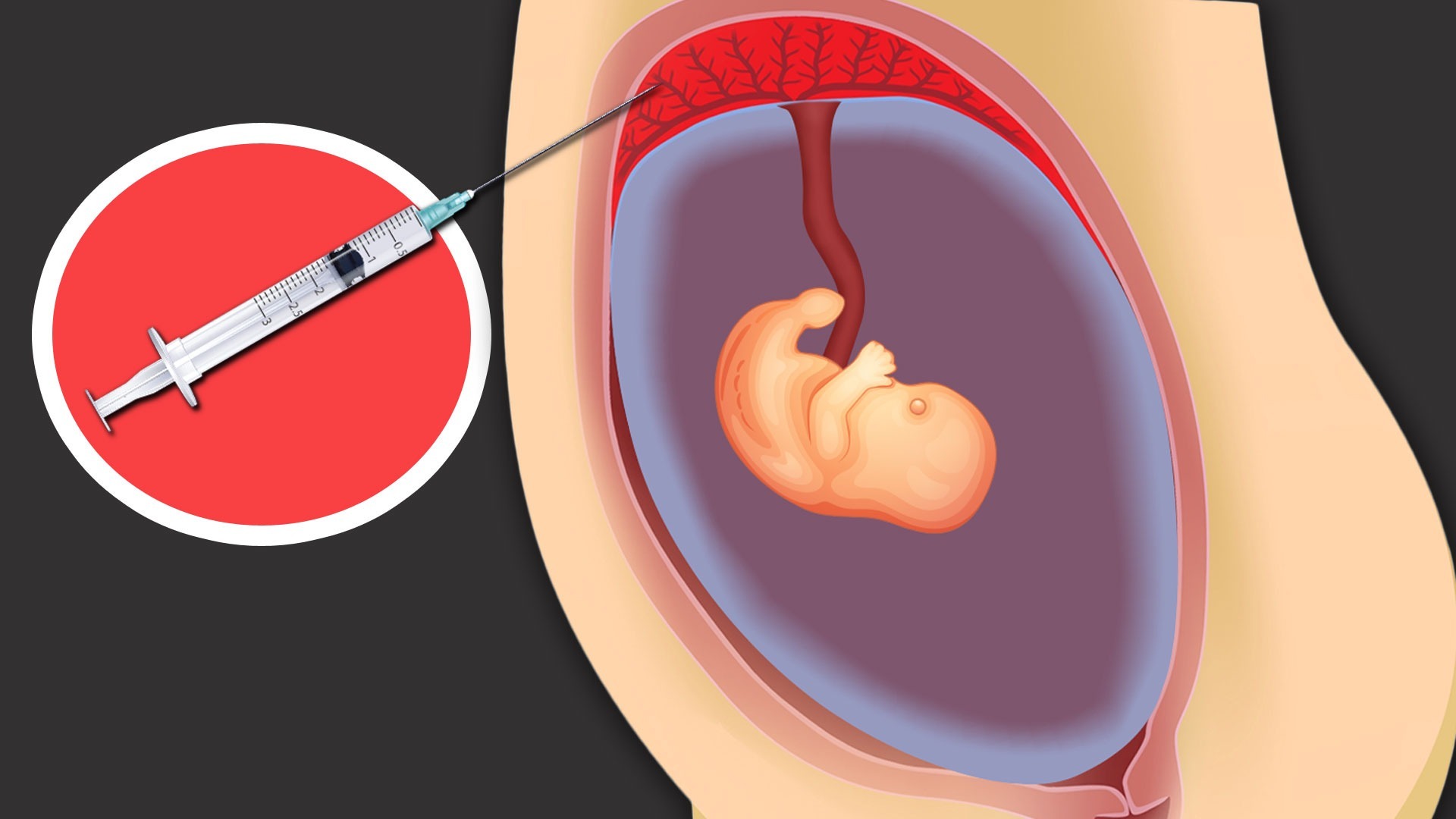 Unveiling Chorionic Villus Sampling (CVS): A Comprehensive Guide - MyShishu