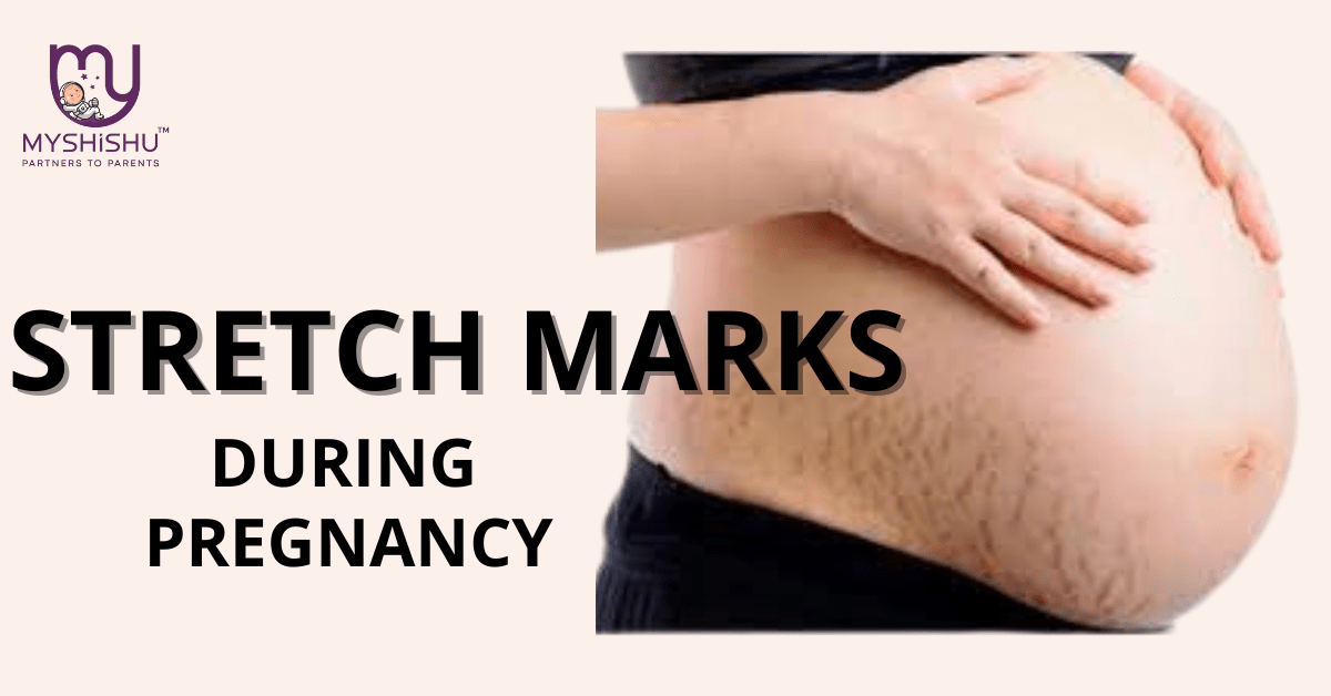 Stretch Marks & Motherhood: A Comprehensive Guide for the Scars of ...