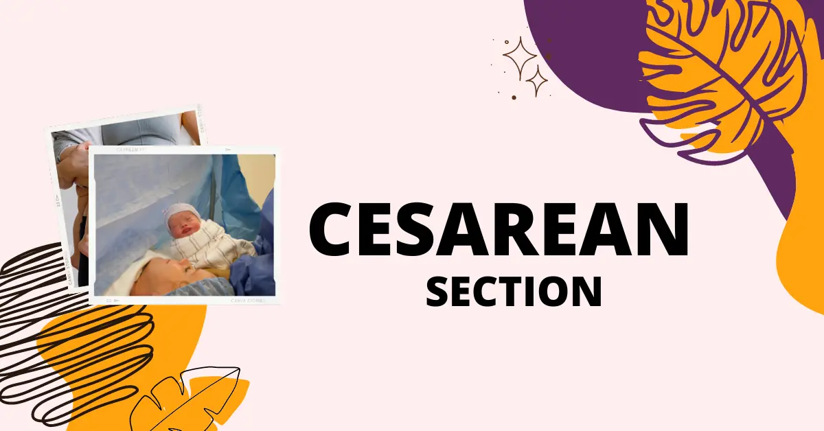 Cesarean section: A Comprehensive Guide